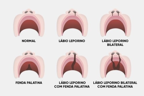 Fenda Lábio-palatina, o que é? Como intervir? - Linha White