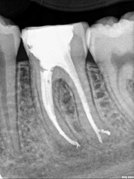 Pulpite Hiperplásica (Inflamação pulpar crónica) - Linha White