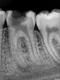 Pulpite Hiperplásica (Inflamação pulpar crónica) - Linha White