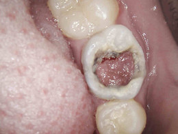 Pulpite Hiperplásica (Inflamação pulpar crónica) - Linha White